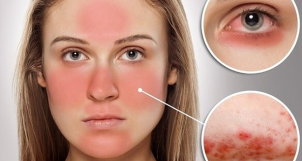 Bệnh Lupus ban đỏ và những biến chứng bạn cần biết - Trình dược viên